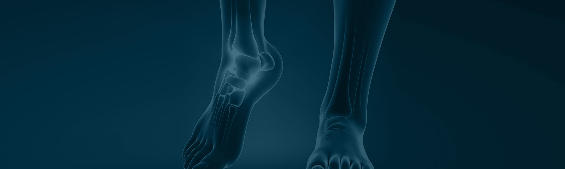Arthrose de cheville Valence - Chirurgie Orthopedique Valence