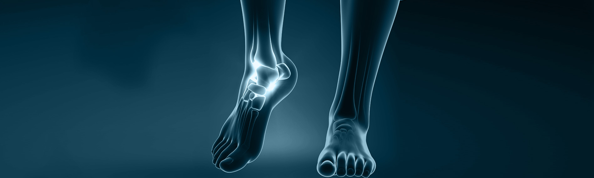 Ligamentoplastie de cheville Valence - Chirurgie Orthopedique Valence