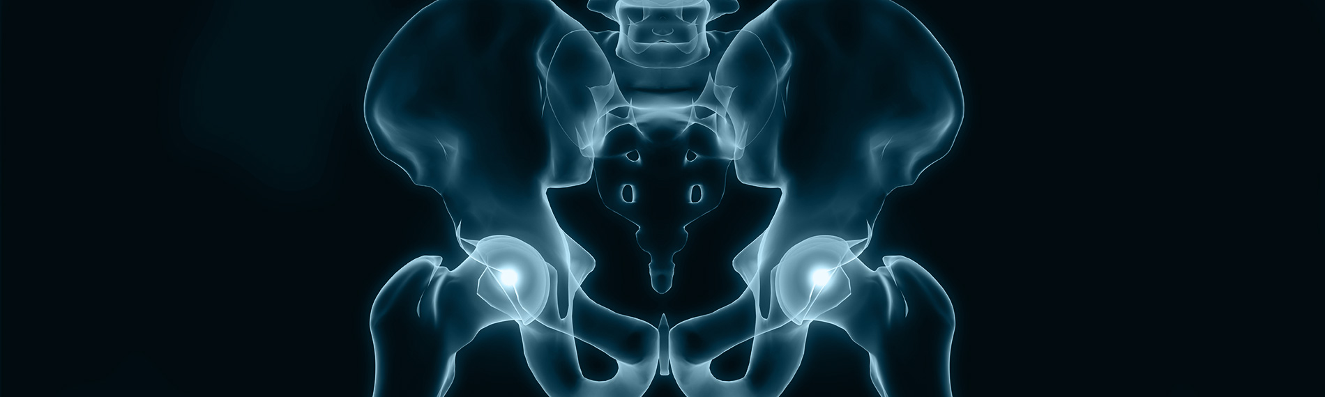 Tendinite du moyen fessier - Chirurgie Orthopedique Valence